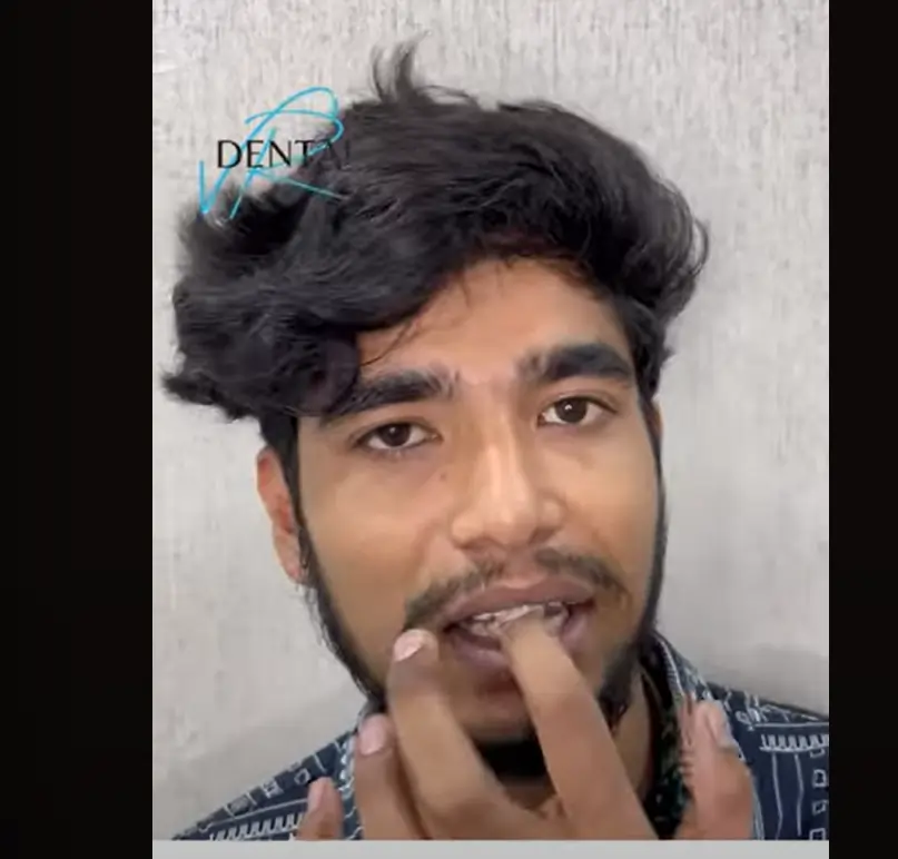 Tooth Clips (Braces) Treatment in Kukatpally – V R Dental